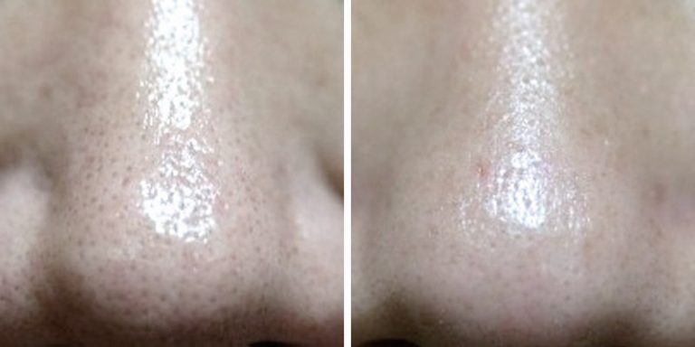 SmartXEL CO2 Skin Resurfacing | Innovative Treatment to Rejuvenating Skin